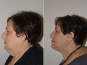 The “Trifecta” Minimally Invasive Procedure To Tighten and Lift the ...