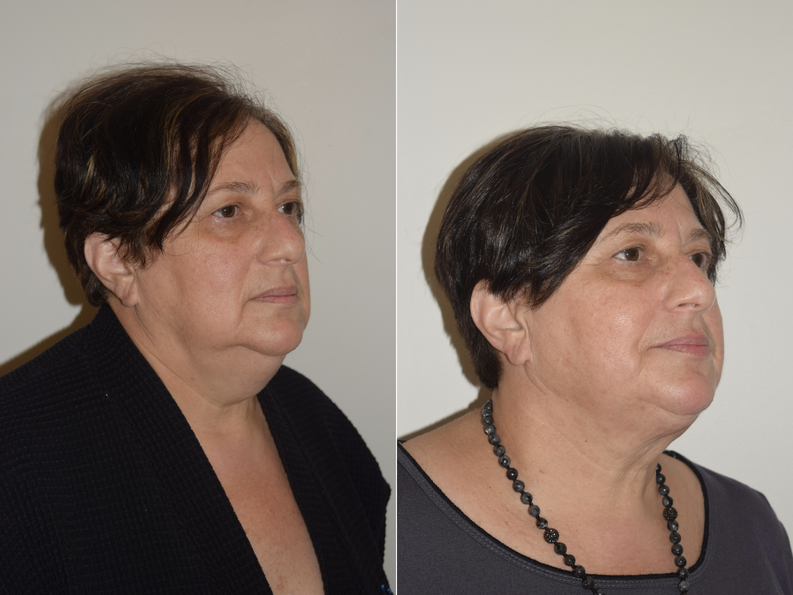 The “Trifecta” Minimally Invasive Procedure To Tighten and Lift the ...