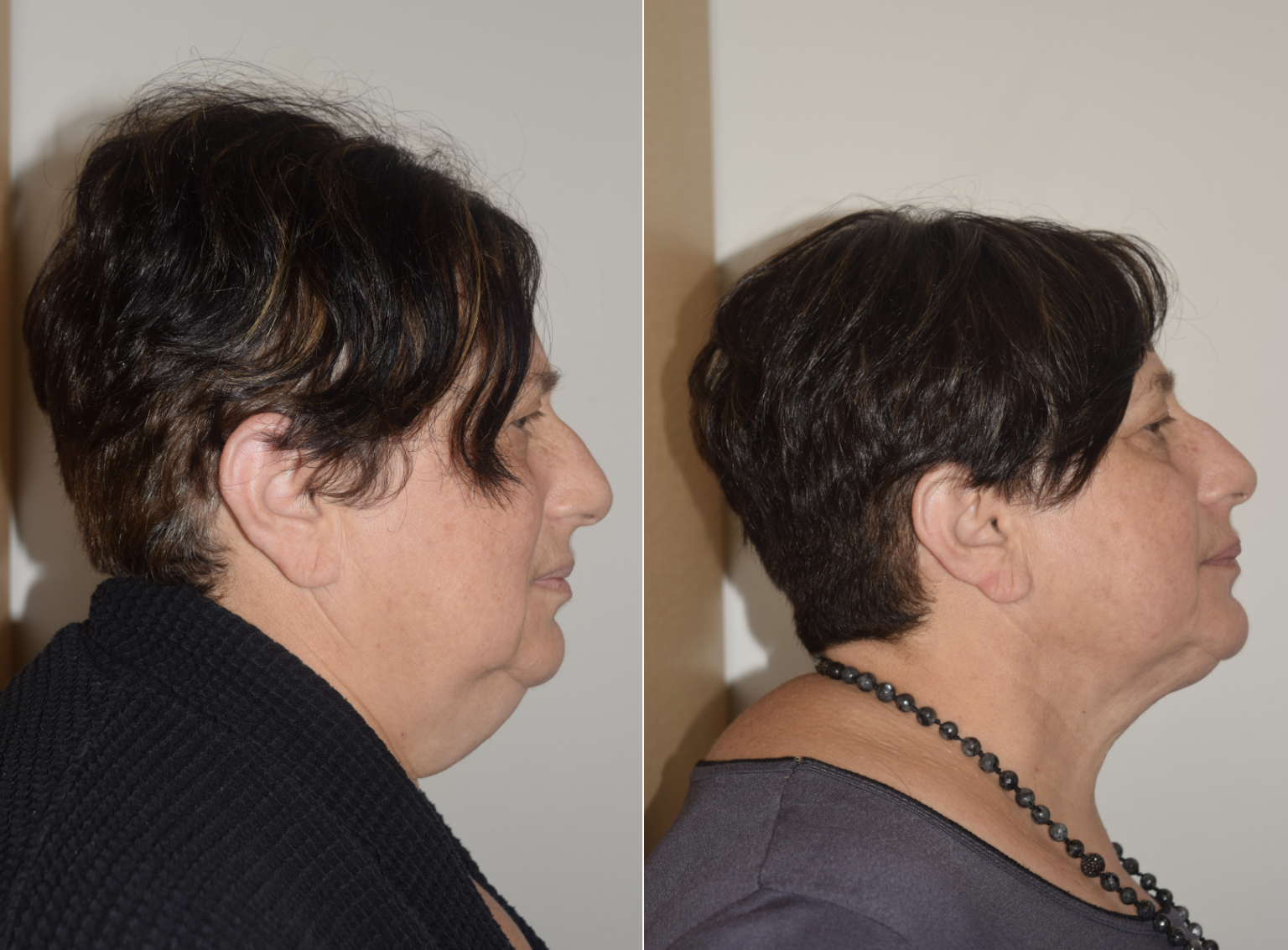 The “Trifecta” Minimally Invasive Procedure To Tighten and Lift the ...